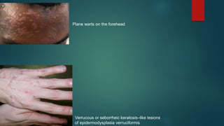 Epidermodysplasia verruciformis and HPV in Immunocompromised | PPT