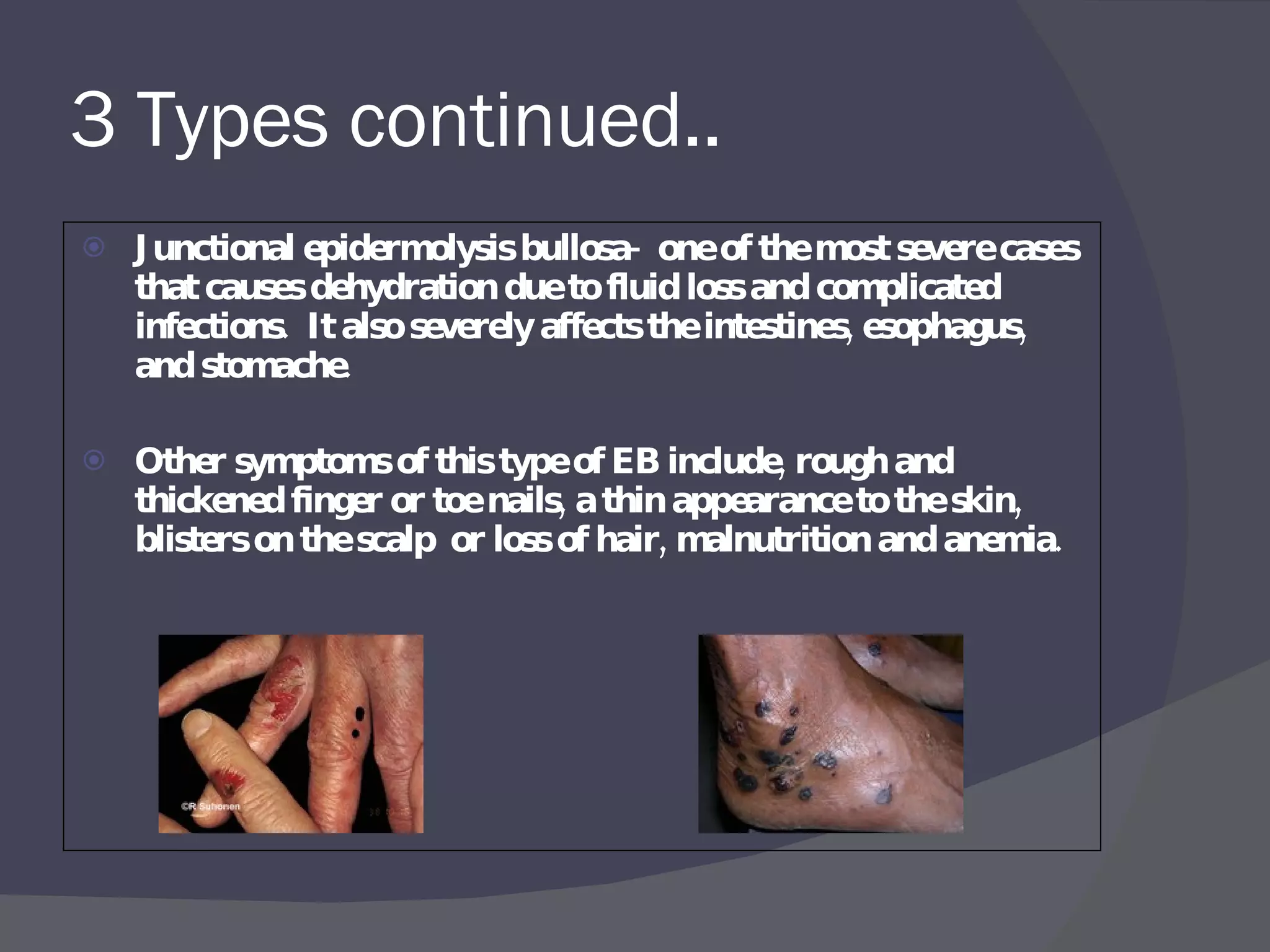 Epidermolysis Bullosa | PPT