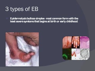 Epidermolysis Bullosa | PPT