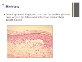 Junctional Epidermolysis Bullosa Histology