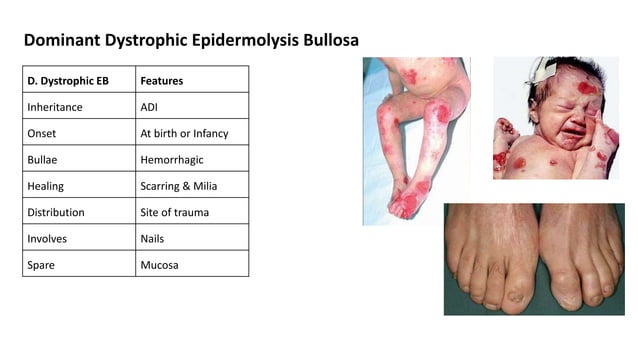Epidermolysis bullosa | PPTX | Skin and Dermatology | Diseases and ...