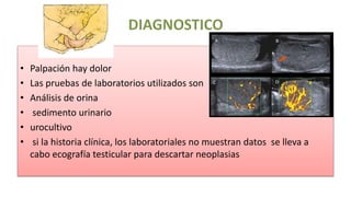Epididimitis y-orquitis-aguda-y-cronica (1) | PPTX