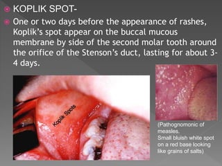 epidofmeasles-180920162327.pdf