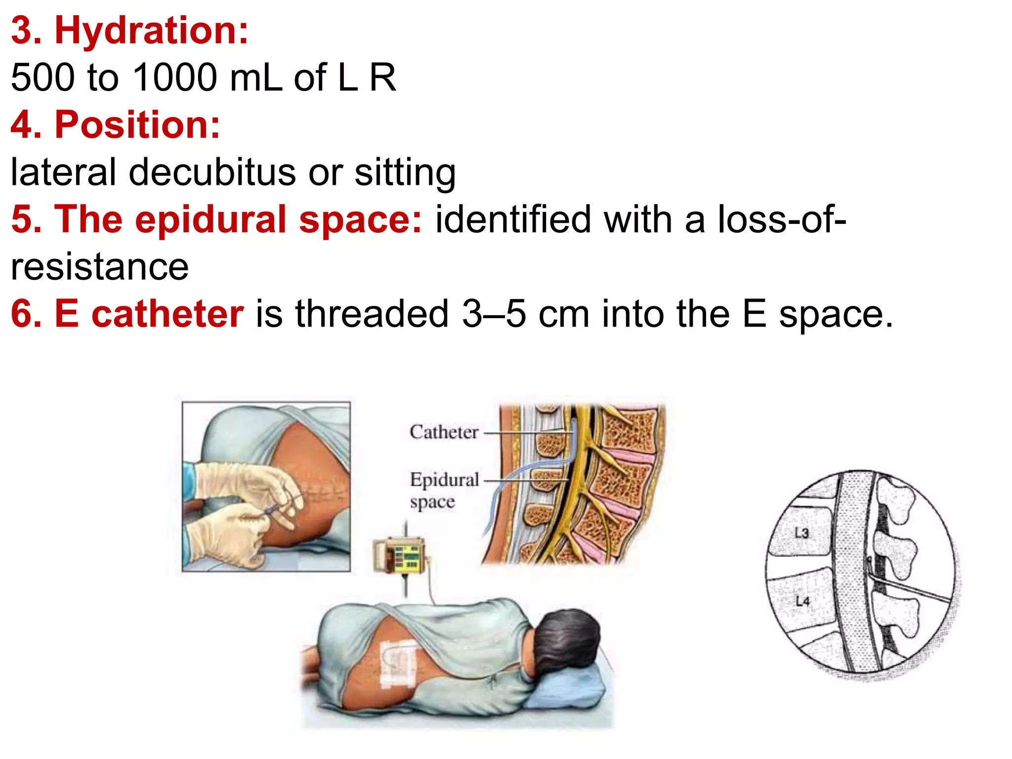Epidural | PDF
