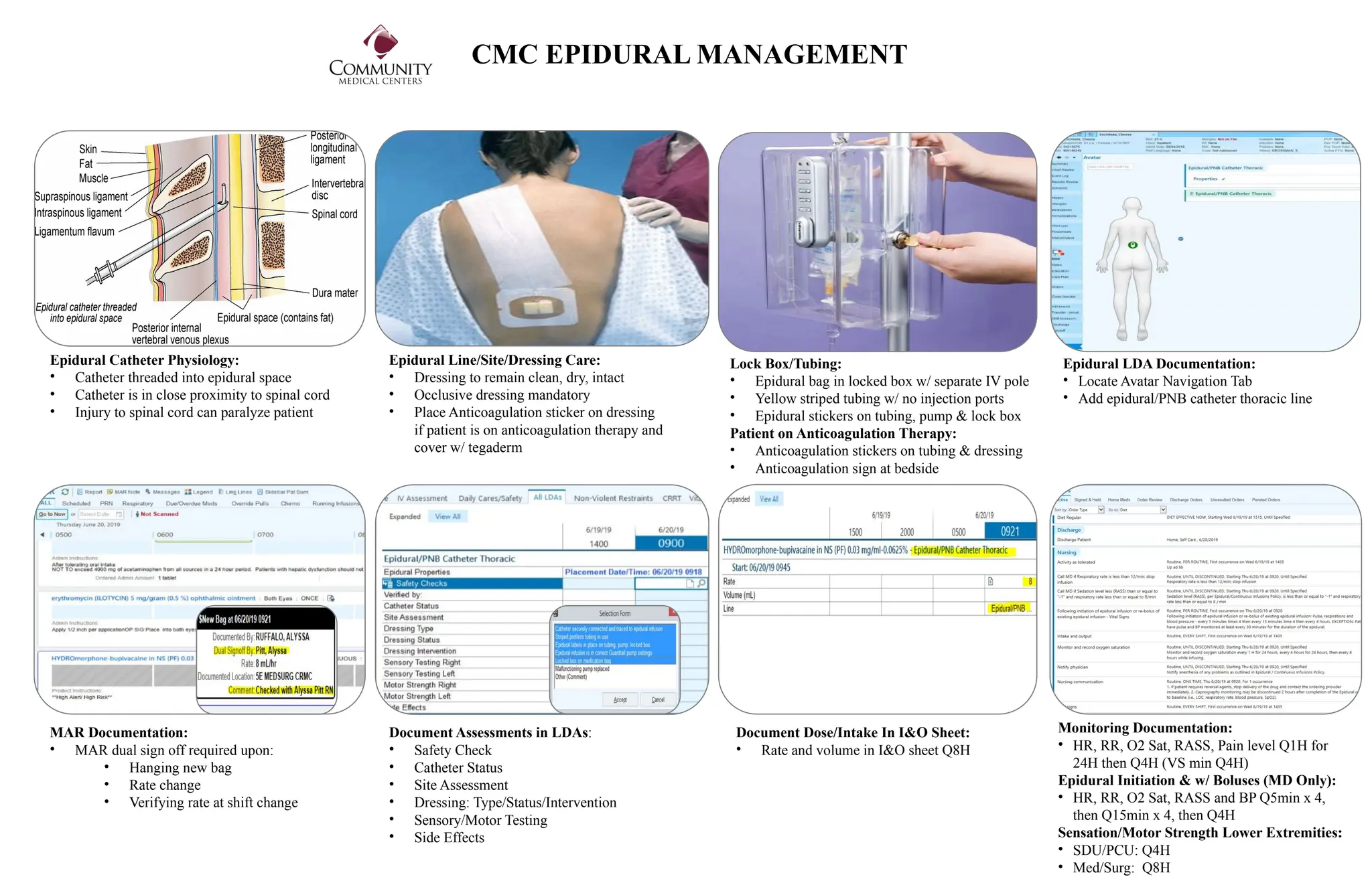 Epidural-Poster.pptx epidural posture123 | PPTX