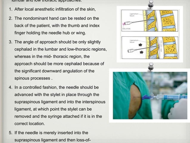 Epidural (1) | PPTX | Brain and Nervous System Disorders | Diseases and ...