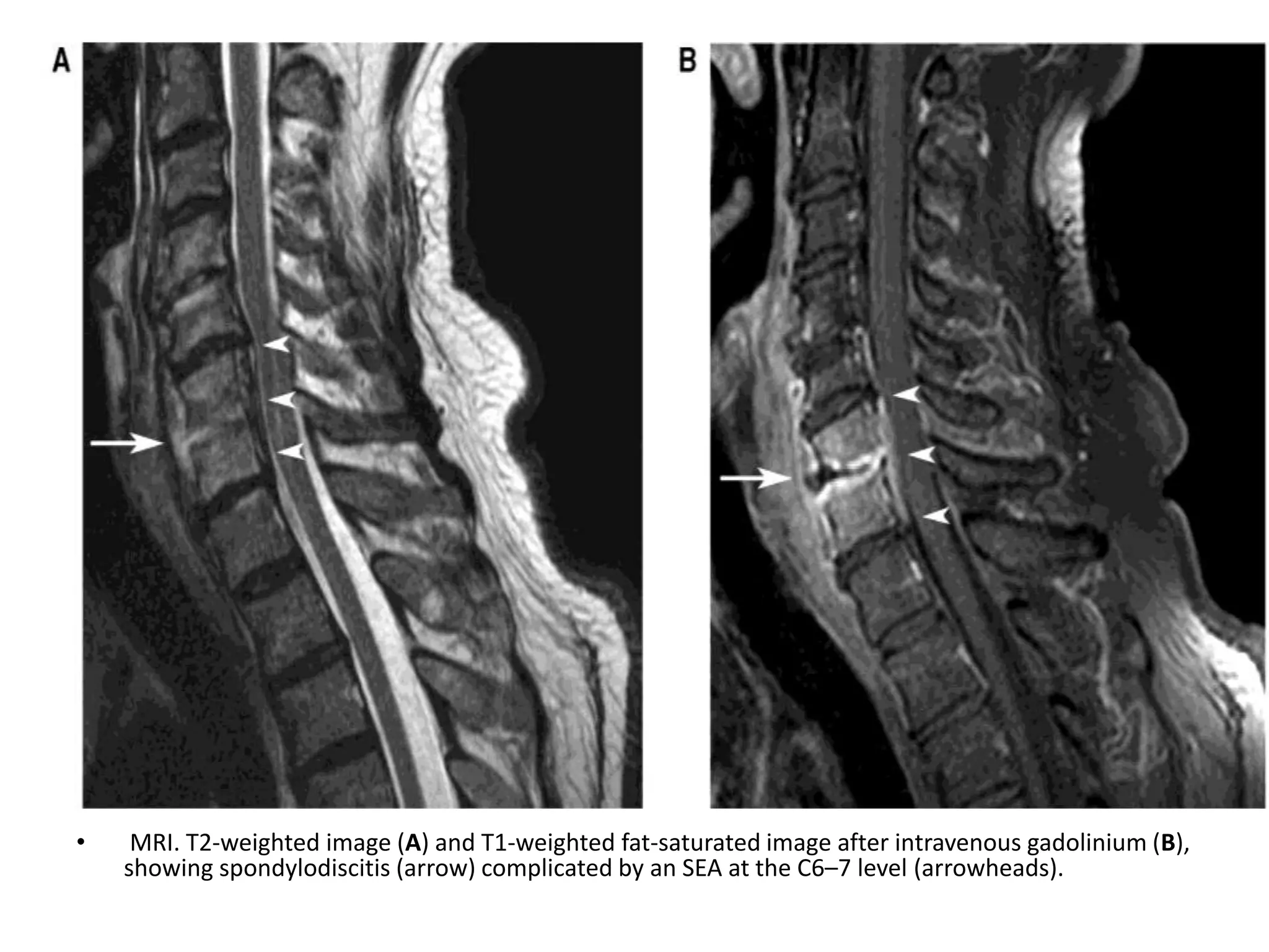 Epidural abscess | PPTX