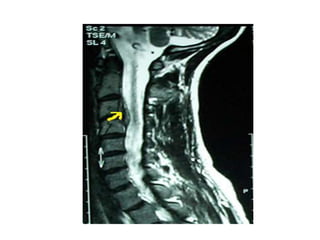 Epidural abscess | PPTX