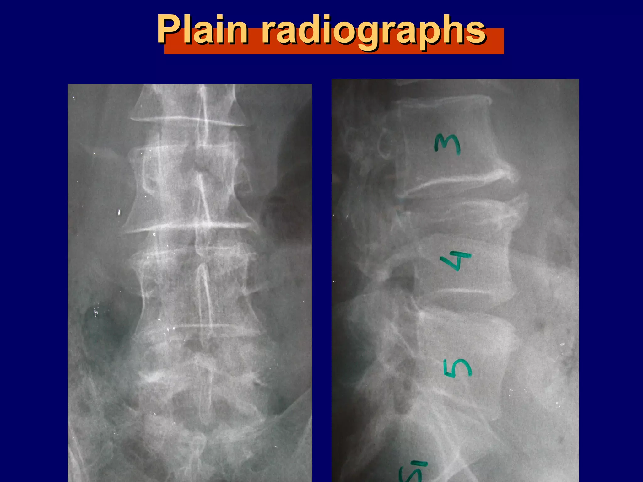 SPINAL EPIDURAL, AND SUBDURAL - INTRAMEDULLAR ABSCESSES | PPT
