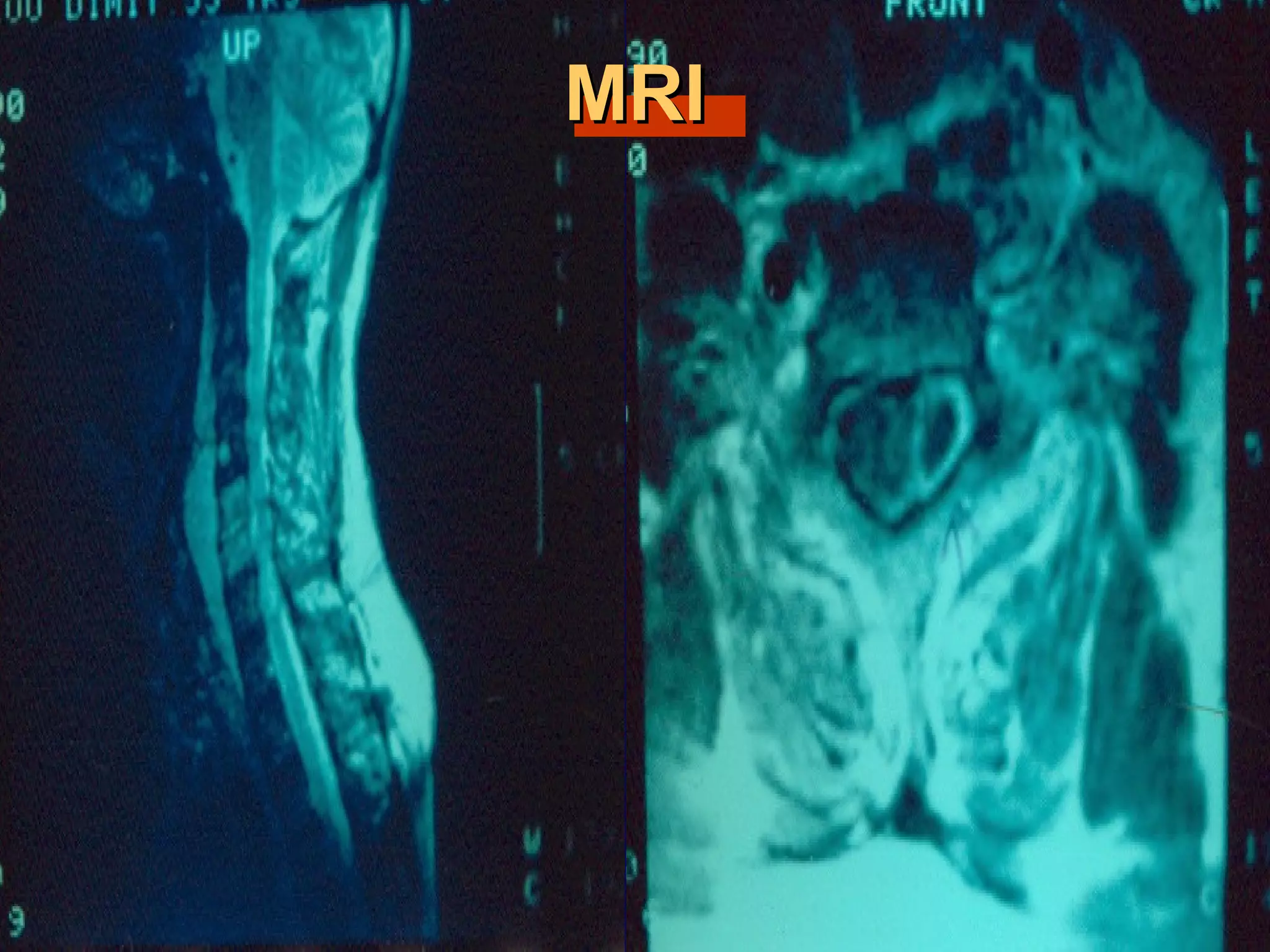 SPINAL EPIDURAL, AND SUBDURAL - INTRAMEDULLAR ABSCESSES | PPT
