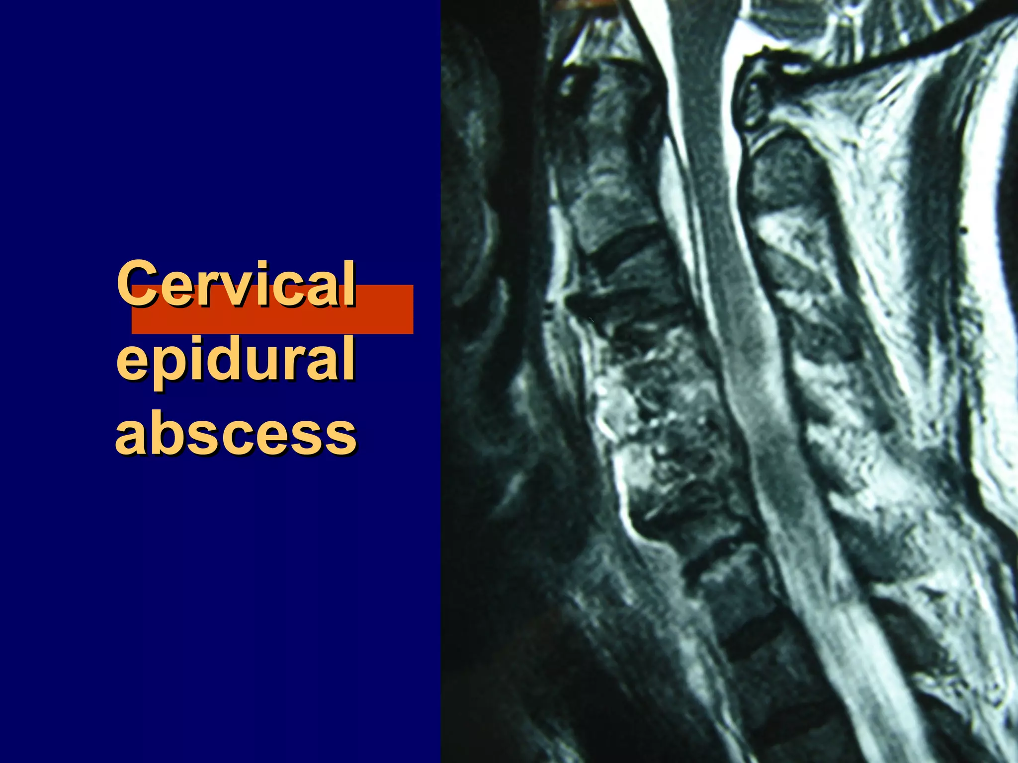 SPINAL EPIDURAL, AND SUBDURAL - INTRAMEDULLAR ABSCESSES | PPT