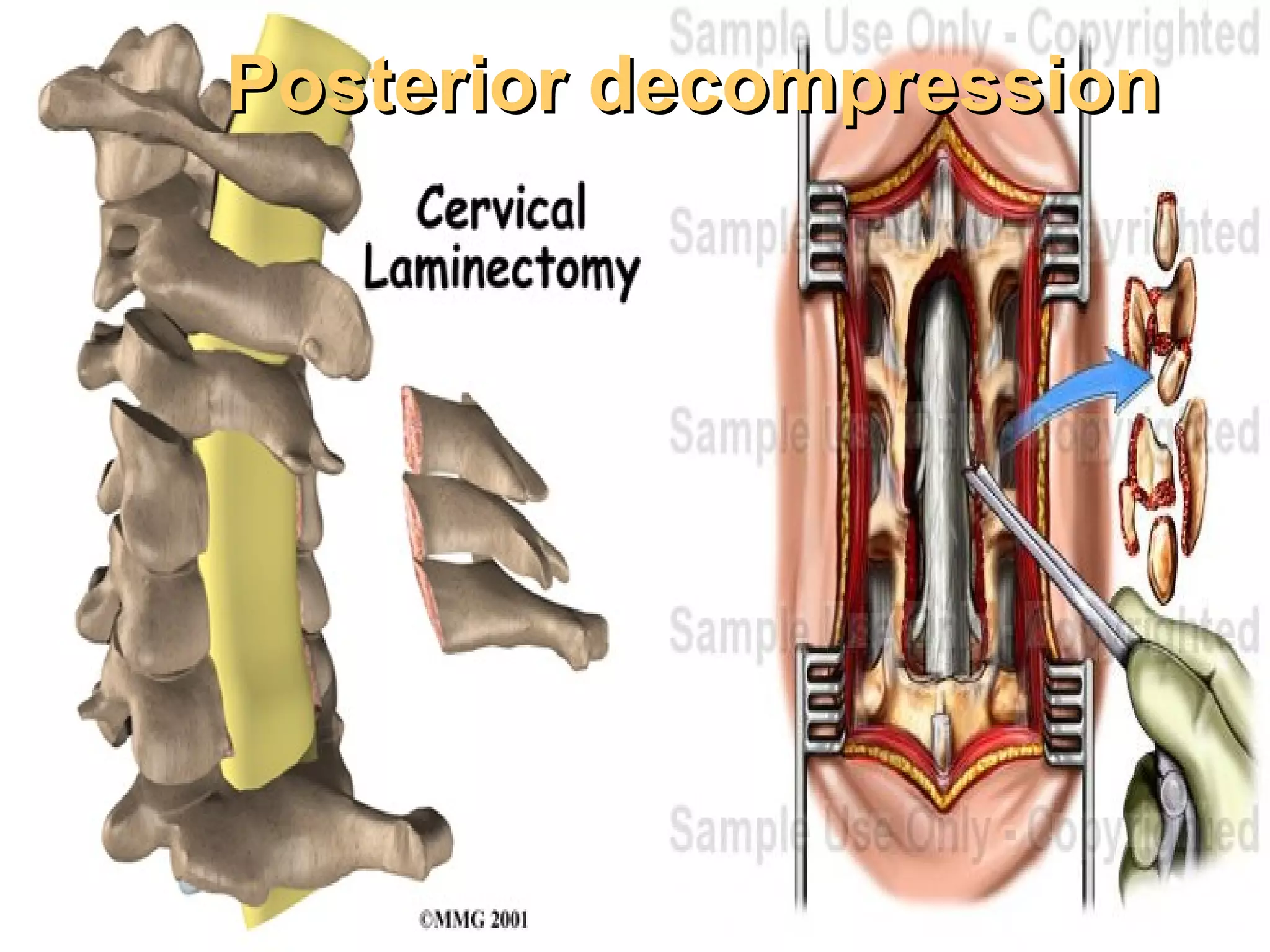 SPINAL EPIDURAL, AND SUBDURAL - INTRAMEDULLAR ABSCESSES | PPT
