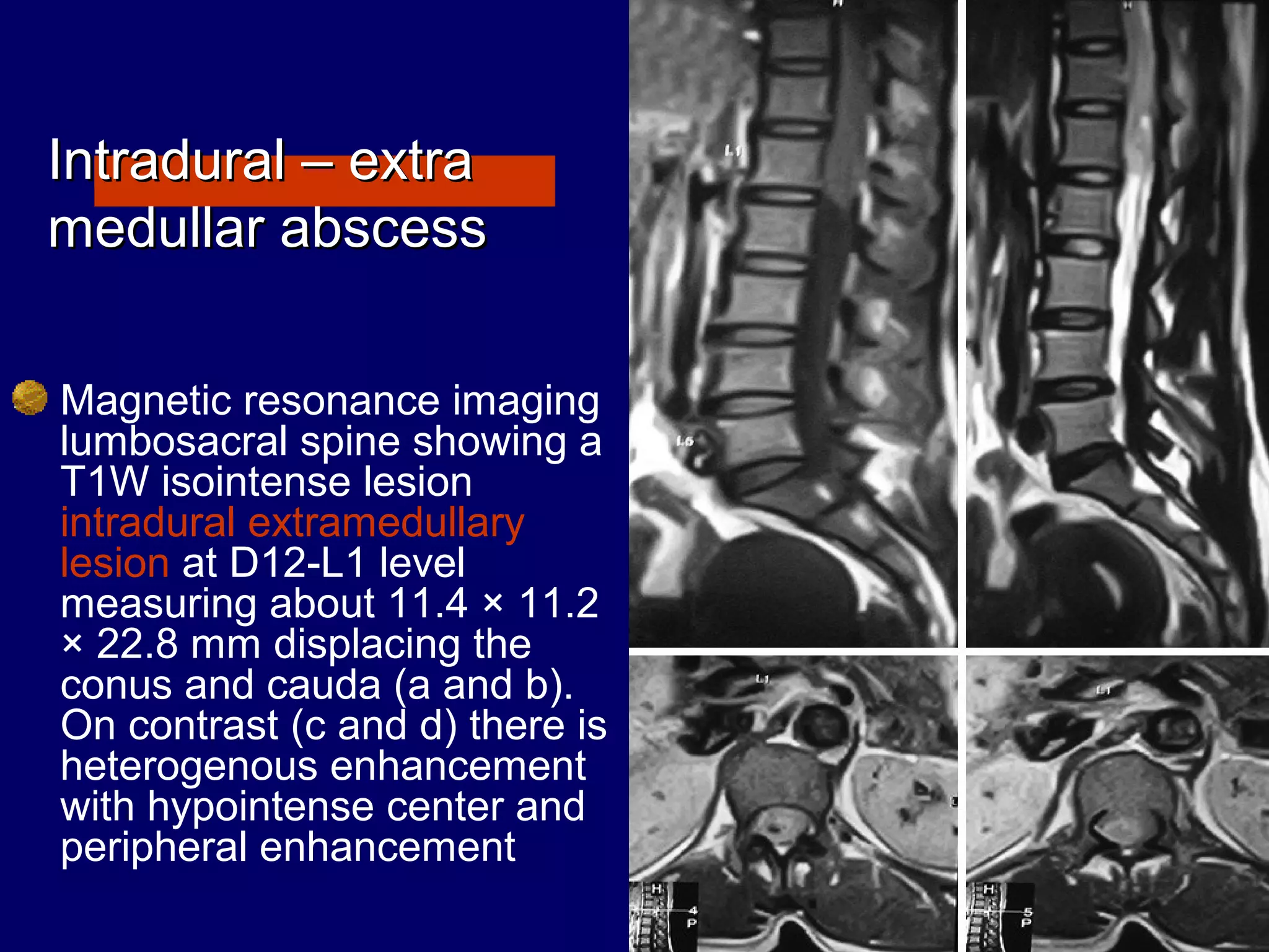 SPINAL EPIDURAL, AND SUBDURAL - INTRAMEDULLAR ABSCESSES | PPT