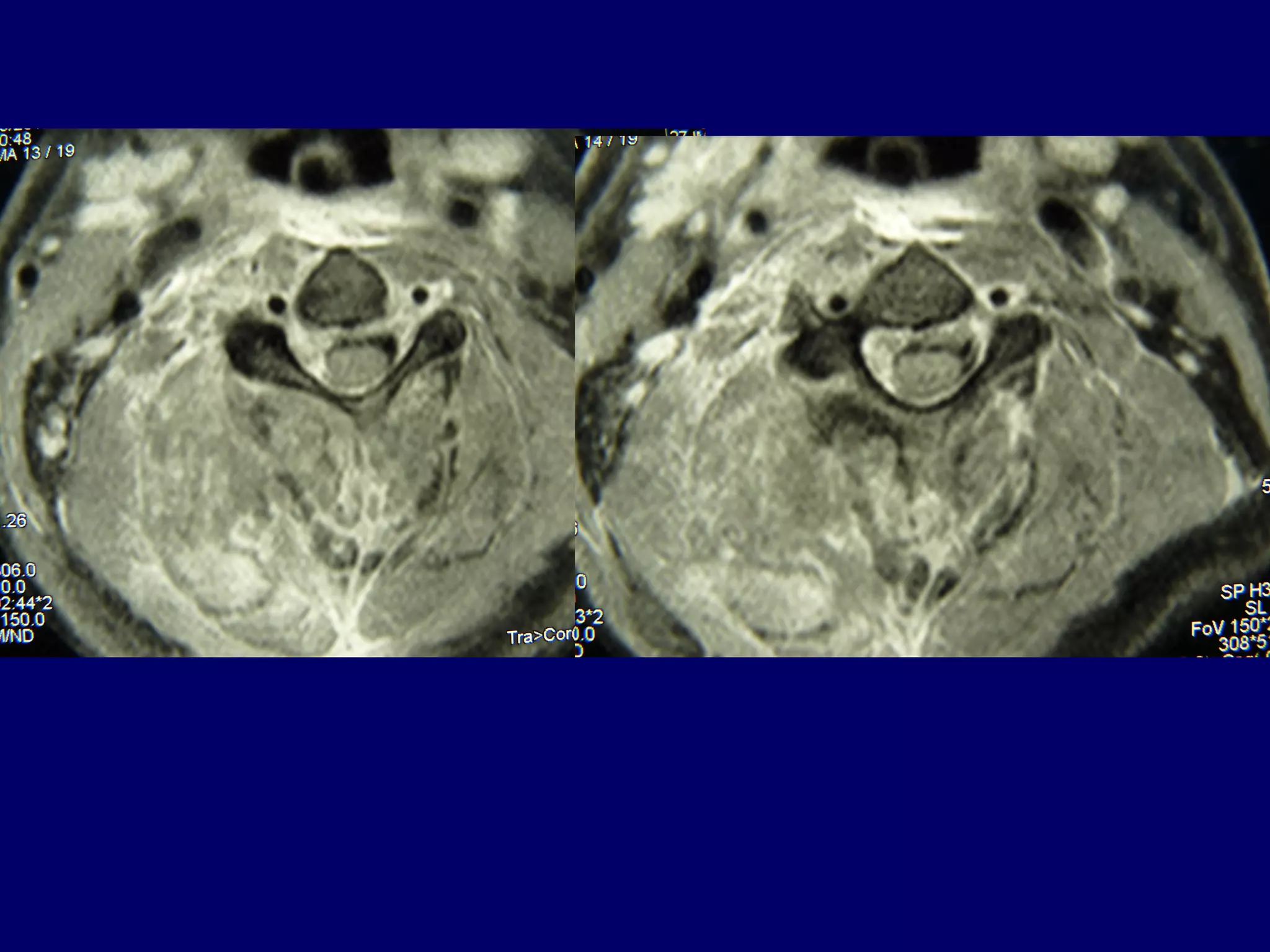 SPINAL EPIDURAL, AND SUBDURAL - INTRAMEDULLAR ABSCESSES | PPT