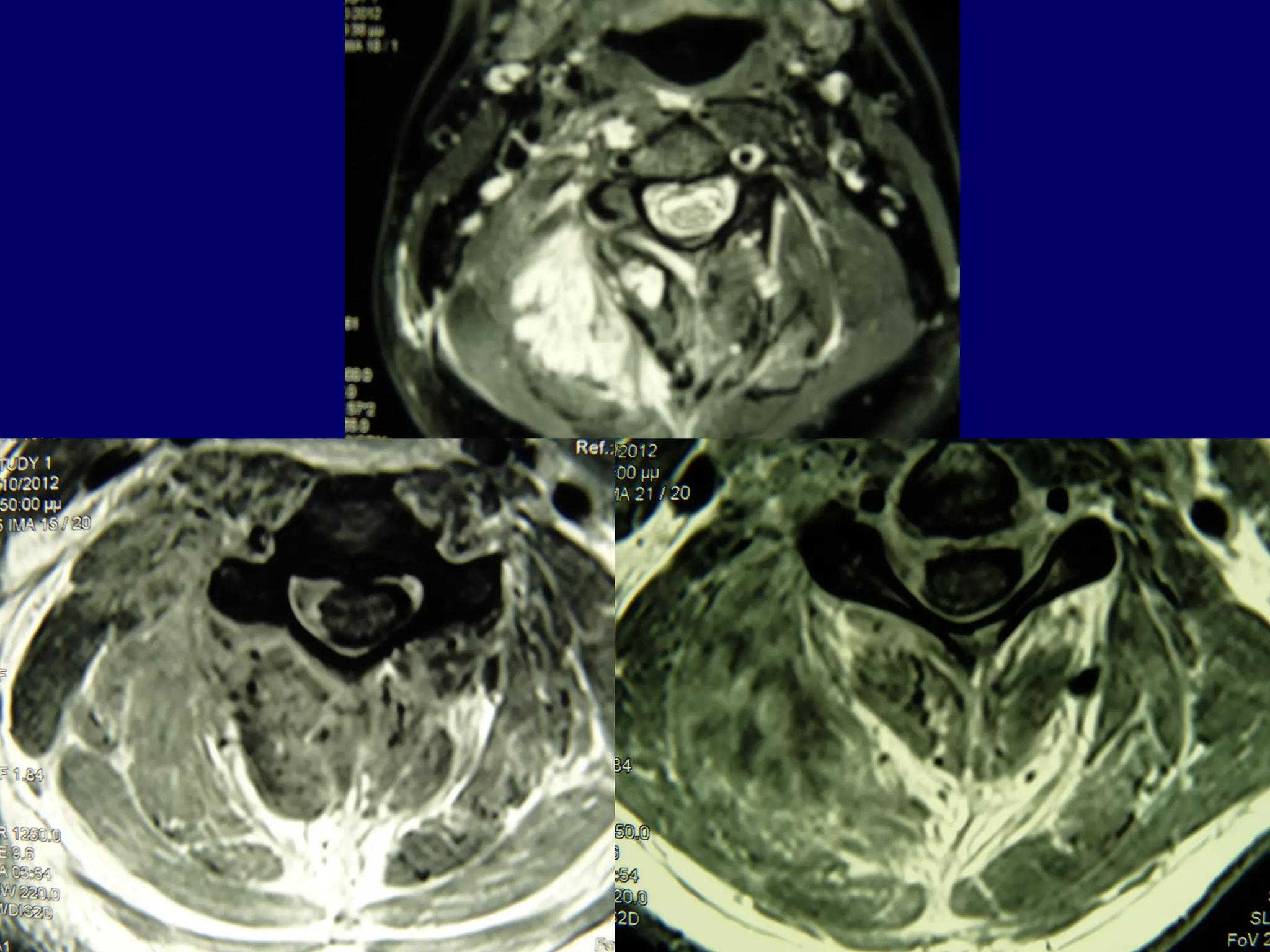 SPINAL EPIDURAL, AND SUBDURAL - INTRAMEDULLAR ABSCESSES | PPT