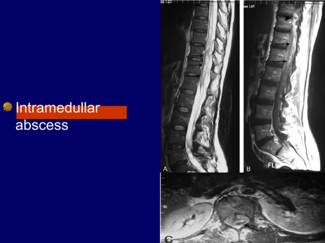 SPINAL EPIDURAL, AND SUBDURAL - INTRAMEDULLAR ABSCESSES | PPT