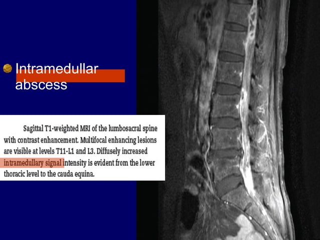 SPINAL EPIDURAL, AND SUBDURAL - INTRAMEDULLAR ABSCESSES | PPT