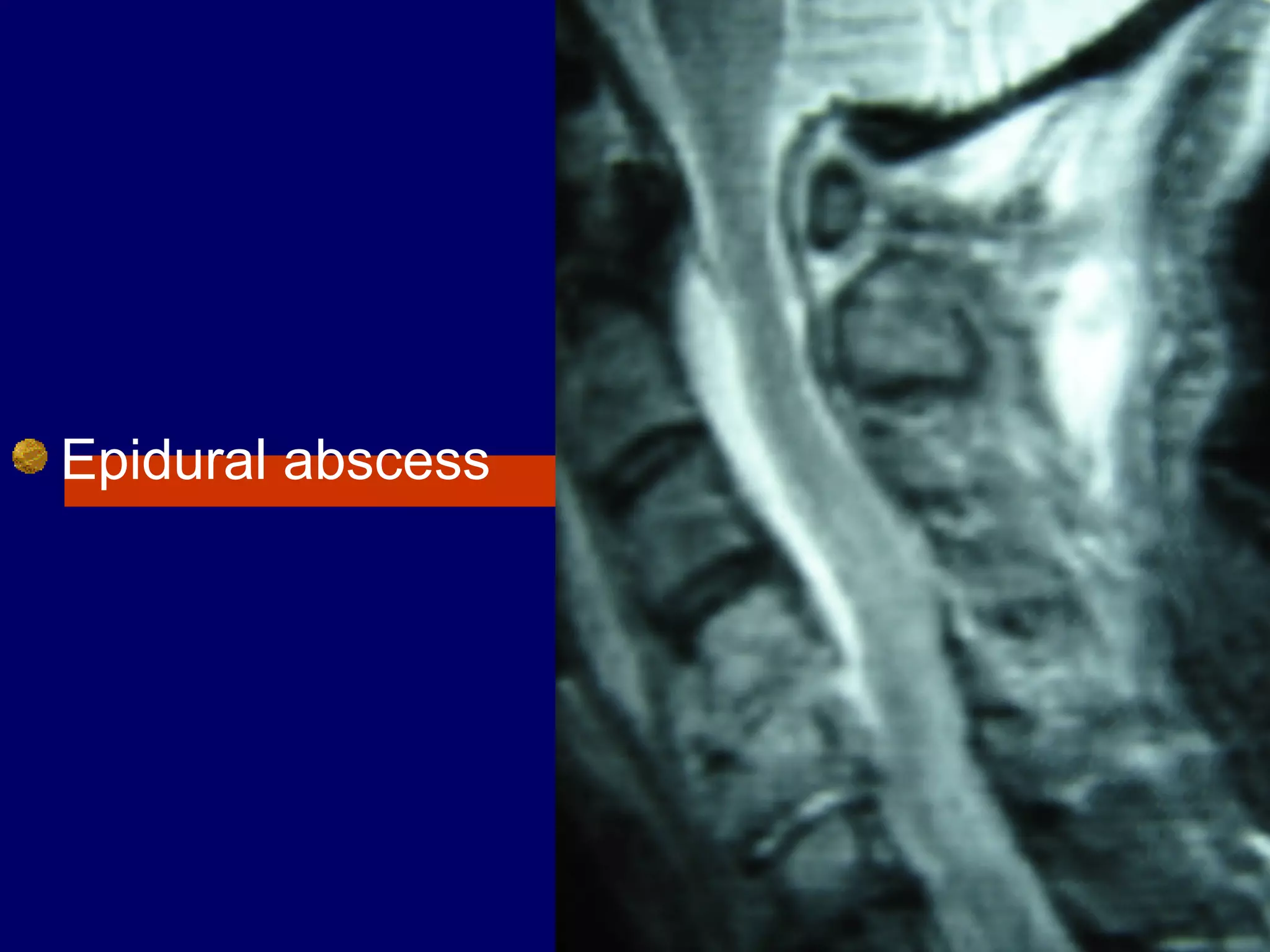 Epidural and subdural abscess | PPT