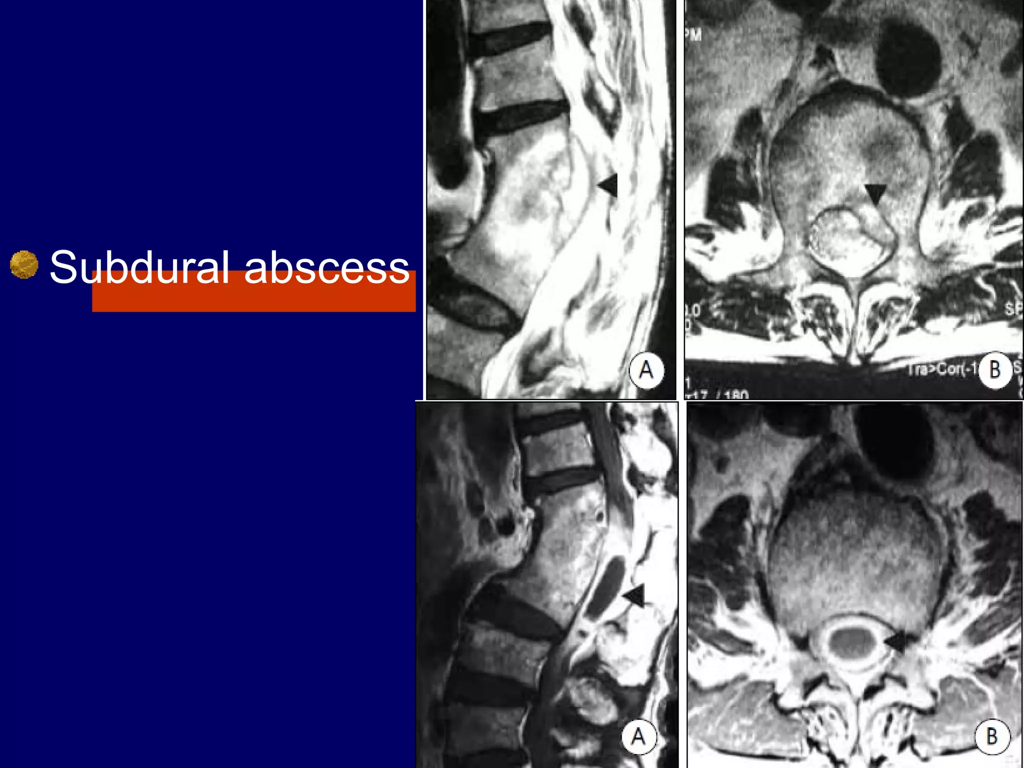 Epidural and subdural abscess | PPT