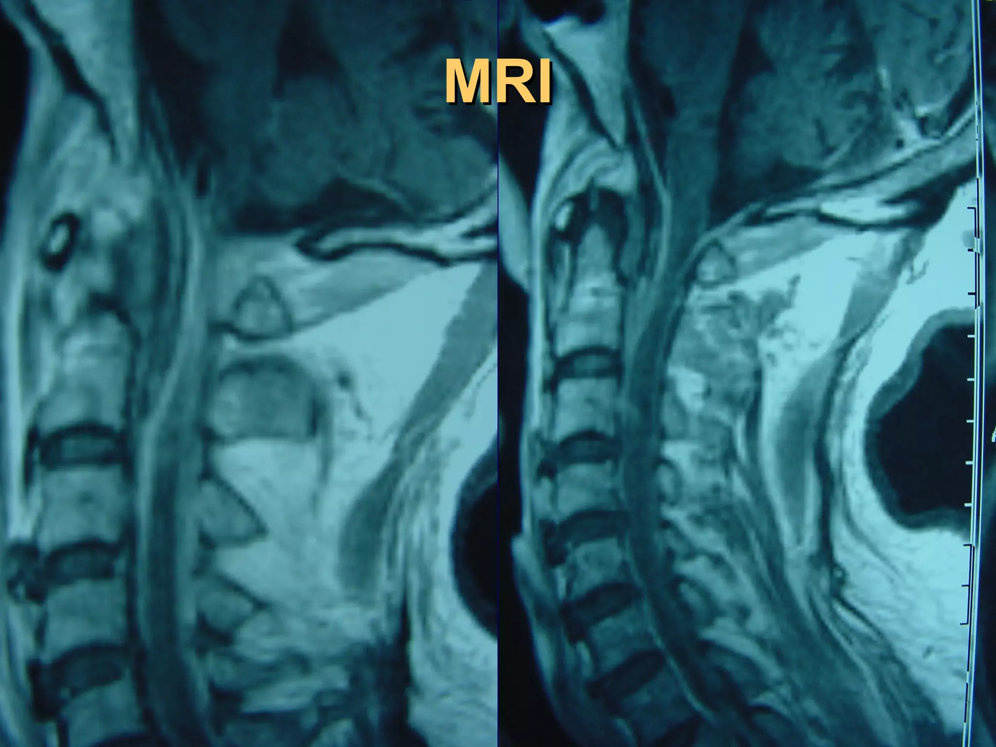 Epidural and subdural abscess | PPT