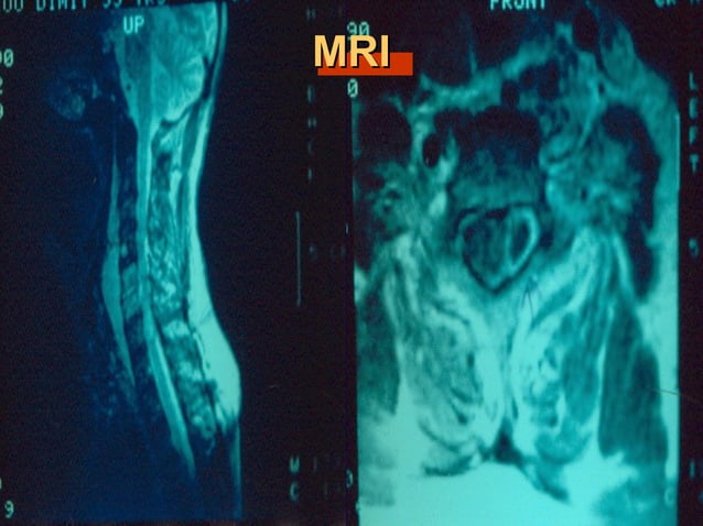Epidural and subdural abscess | PPT