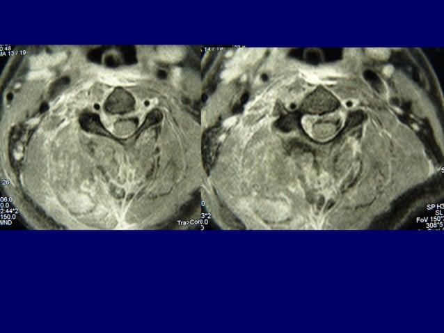 Epidural and subdural abscess | PPT