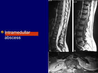 Epidural and subdural abscess | PPT