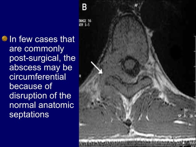 Epidural and subdural abscess