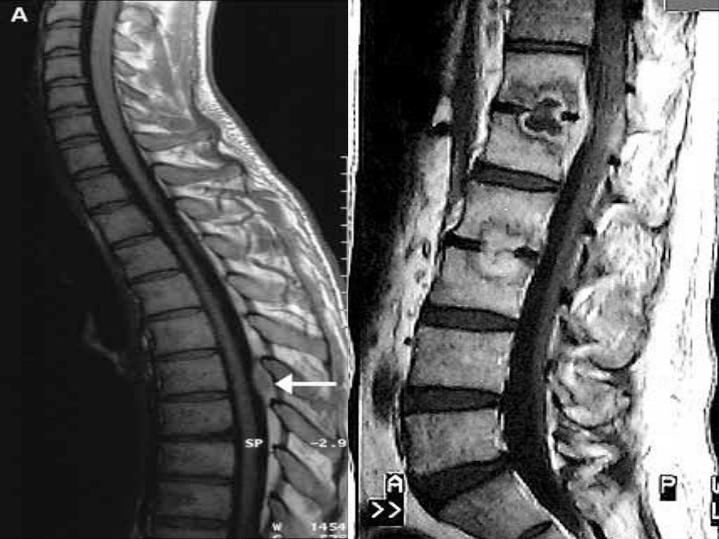Epidural And Subdural Abscess