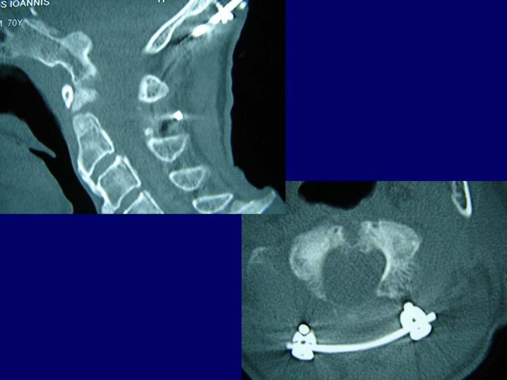 Epidural And Subdural Abscess