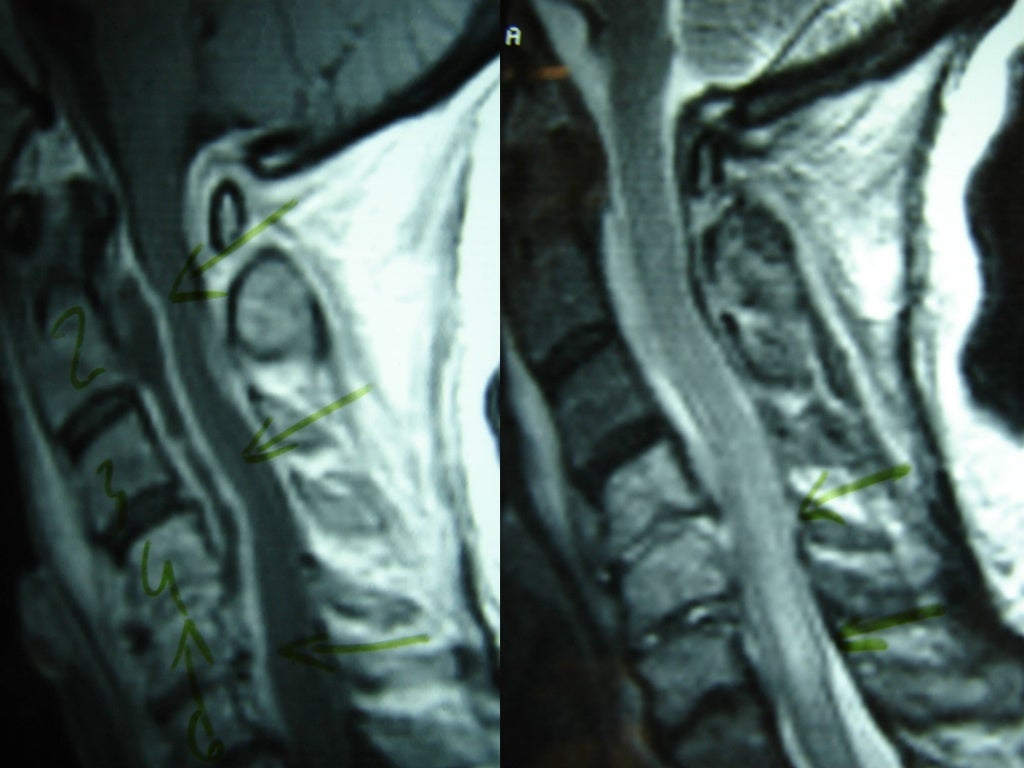 Epidural And Subdural Abscess