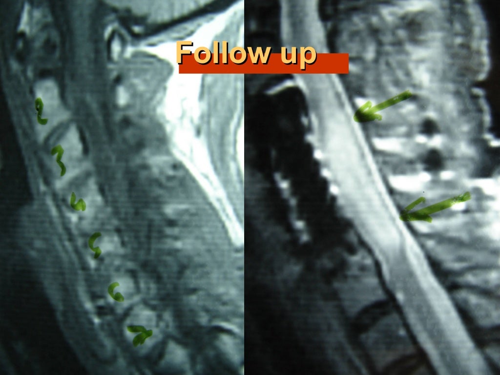 Epidural And Subdural Abscess