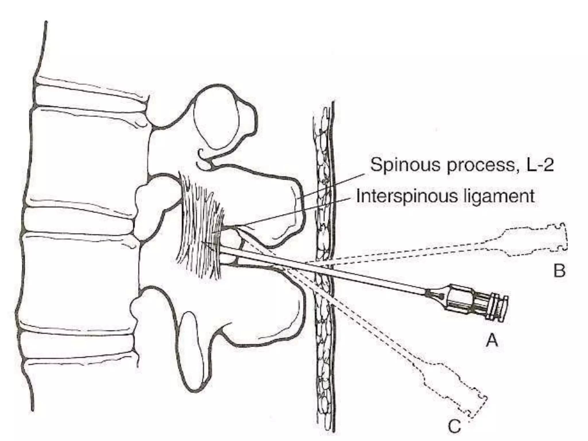 epidural anaesthesia.pptx