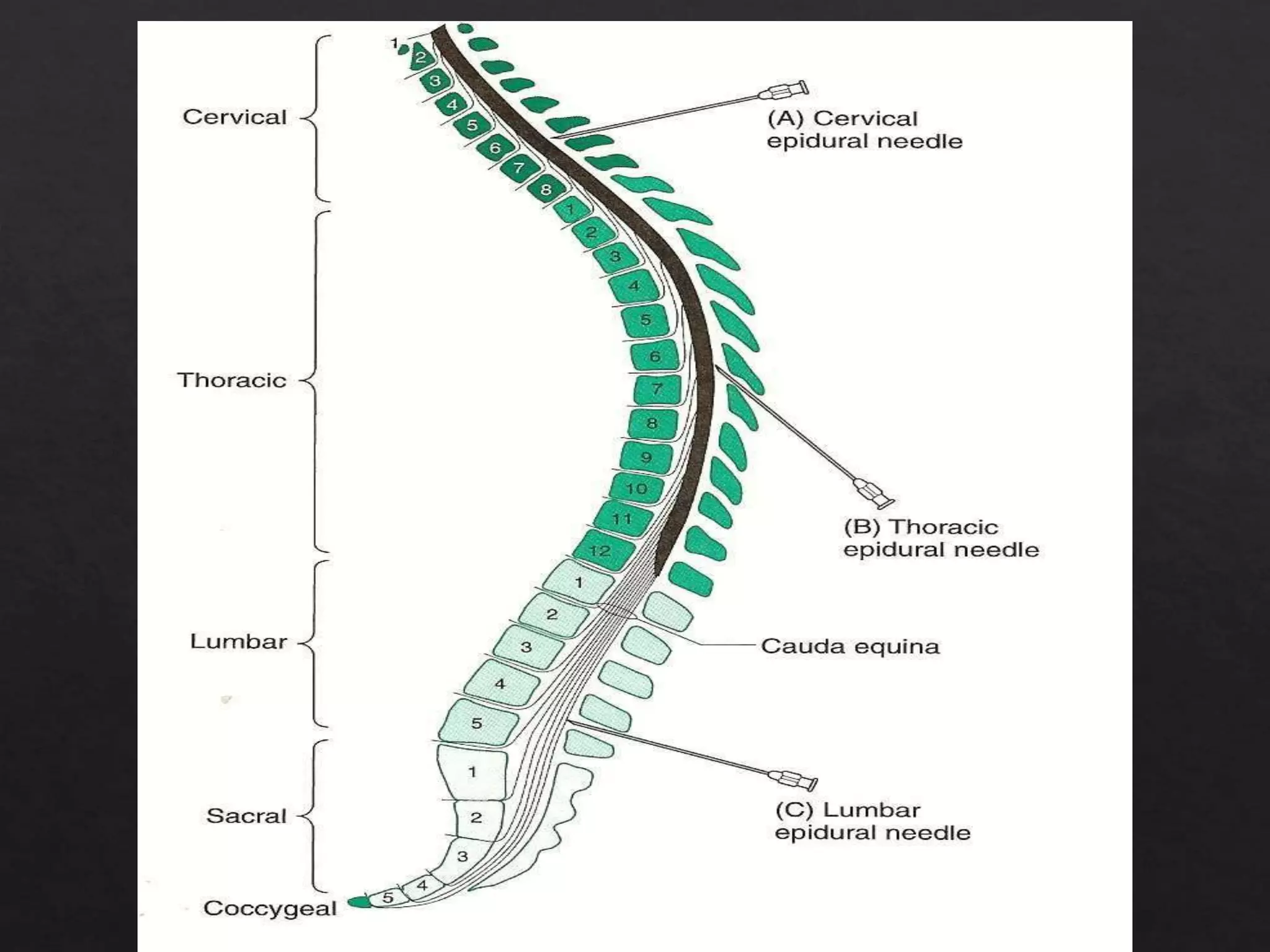 epidural anaesthesia.pptx