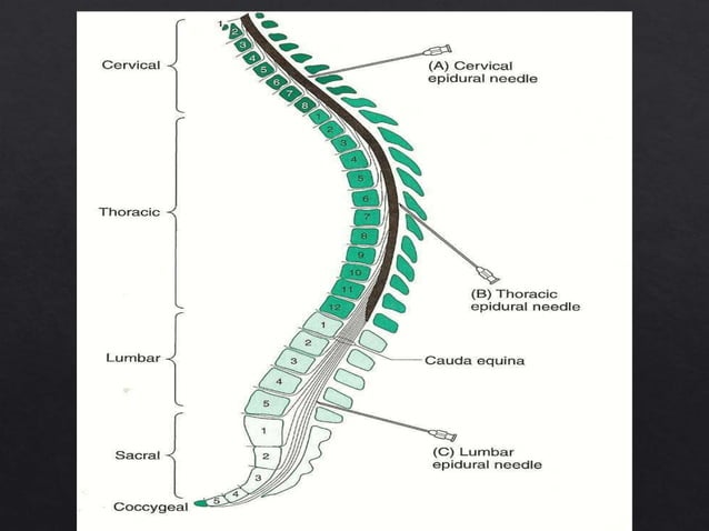 epidural anaesthesia.pptx