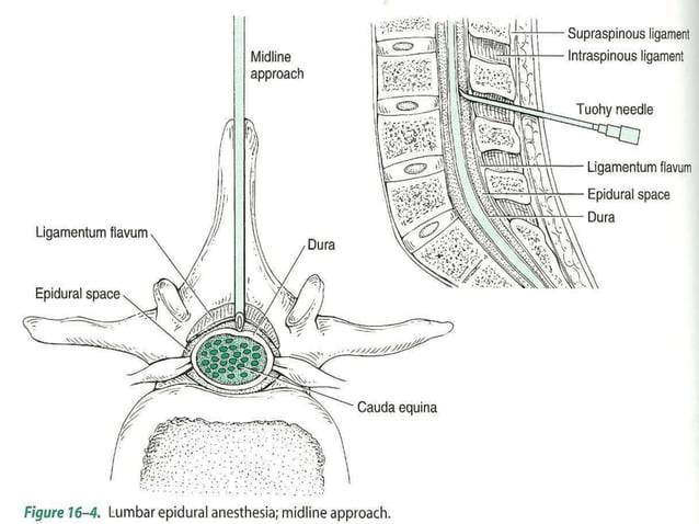 epidural anaesthesia.pptx