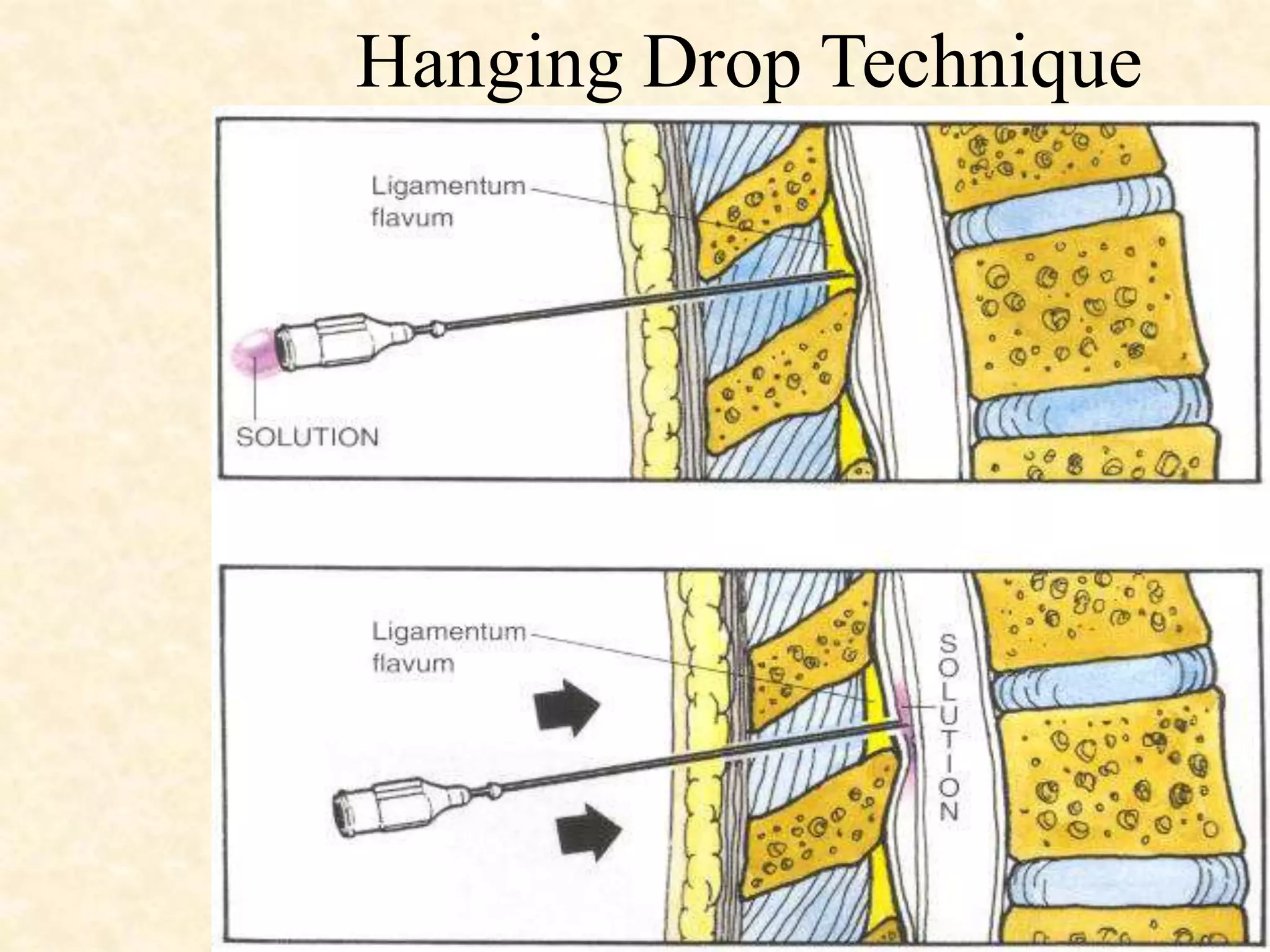 Epidural anaesthesia .pptx