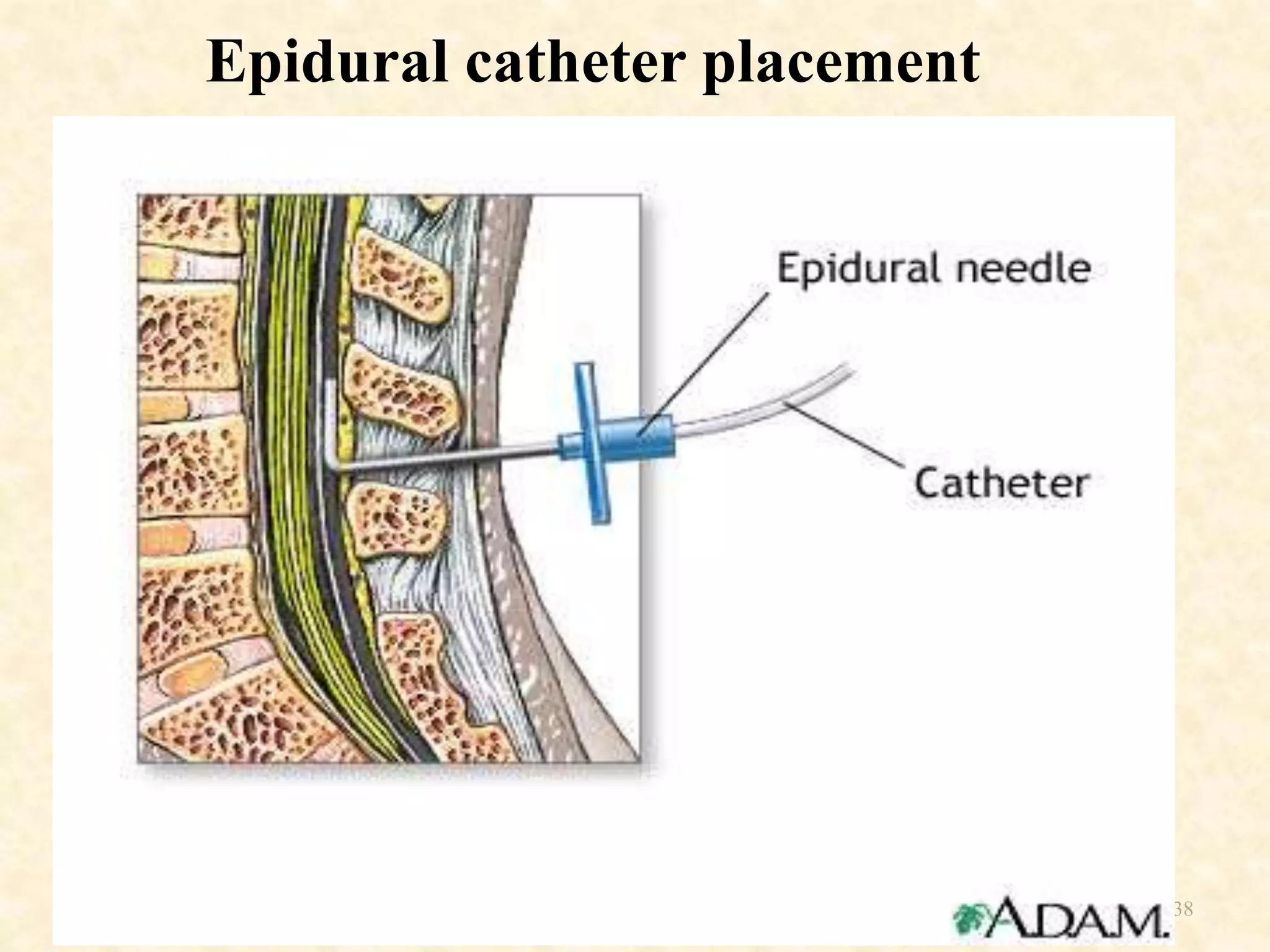 Epidural anaesthesia .pptx