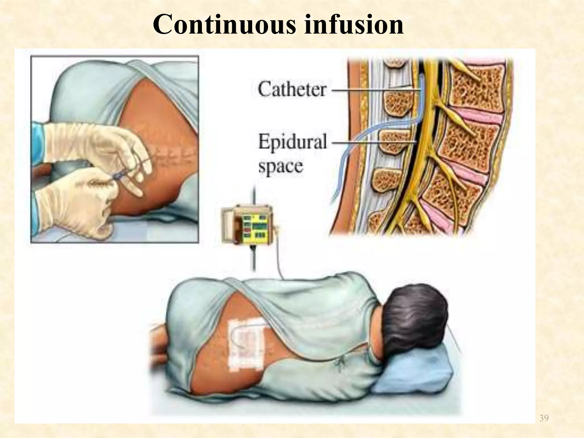 Epidural anaesthesia .pptx