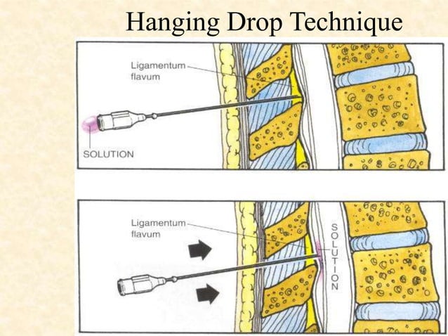 Epidural anaesthesia .pptx | First Aid | Injuries