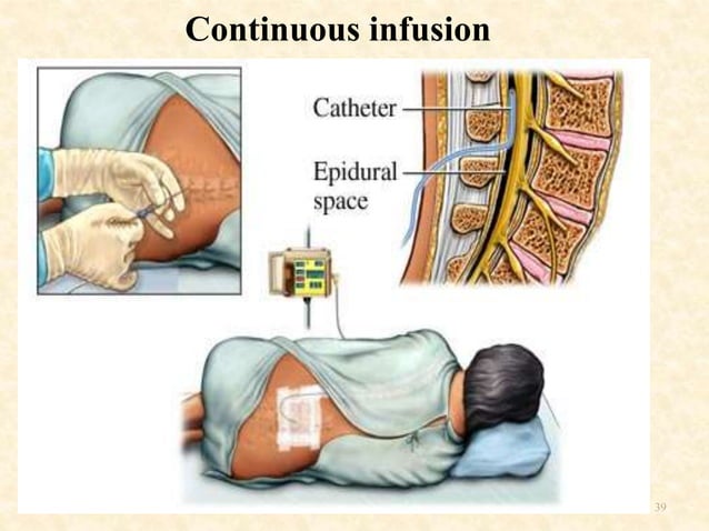 Epidural anaesthesia .pptx | First Aid | Injuries