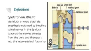 Theory and Techniques in Epidural Anaesthesia | PPTX