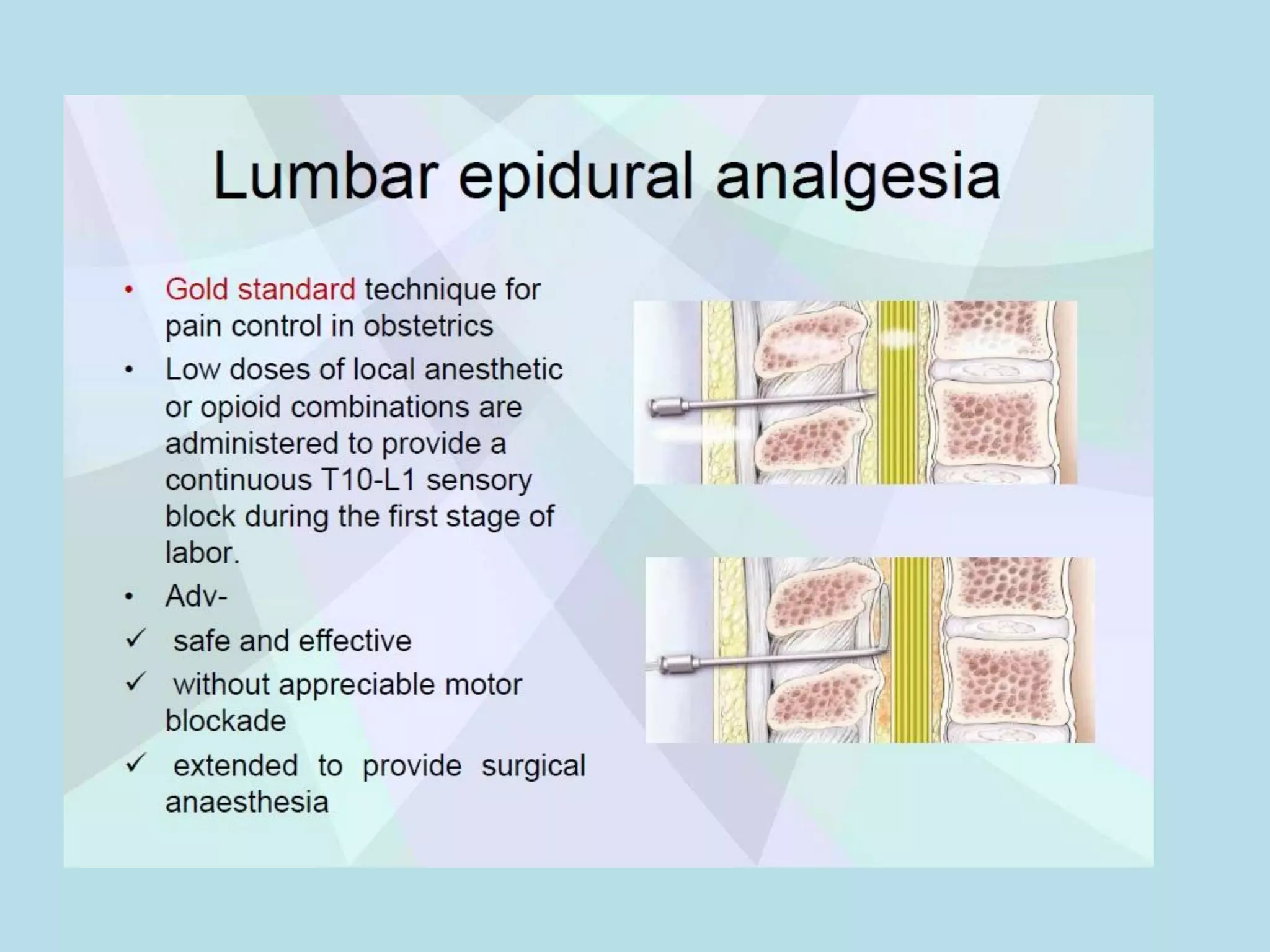 Epidural analgesia for labour | PDF