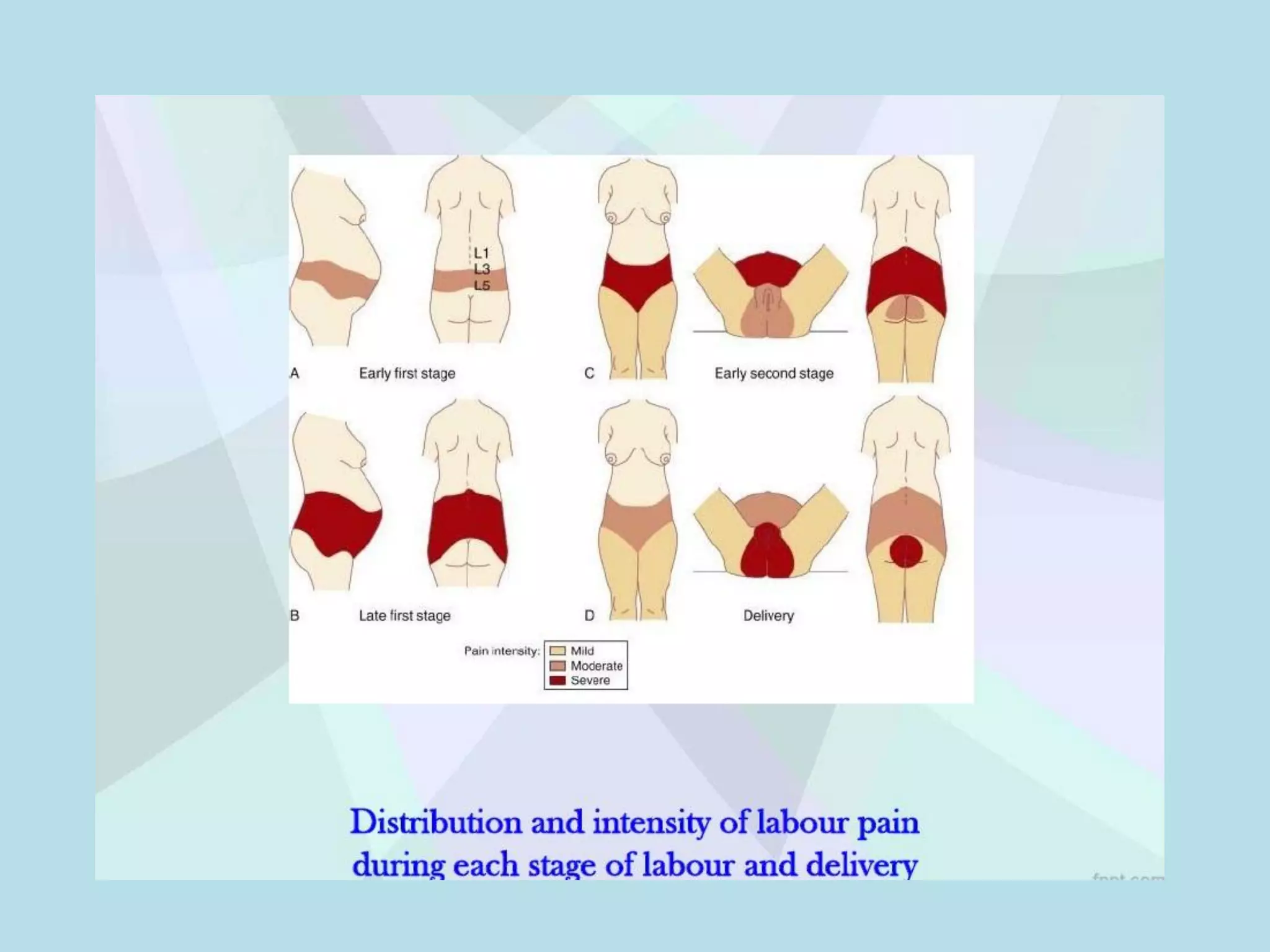 Epidural analgesia for labour | PDF