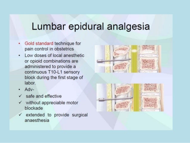 Epidural analgesia for labour