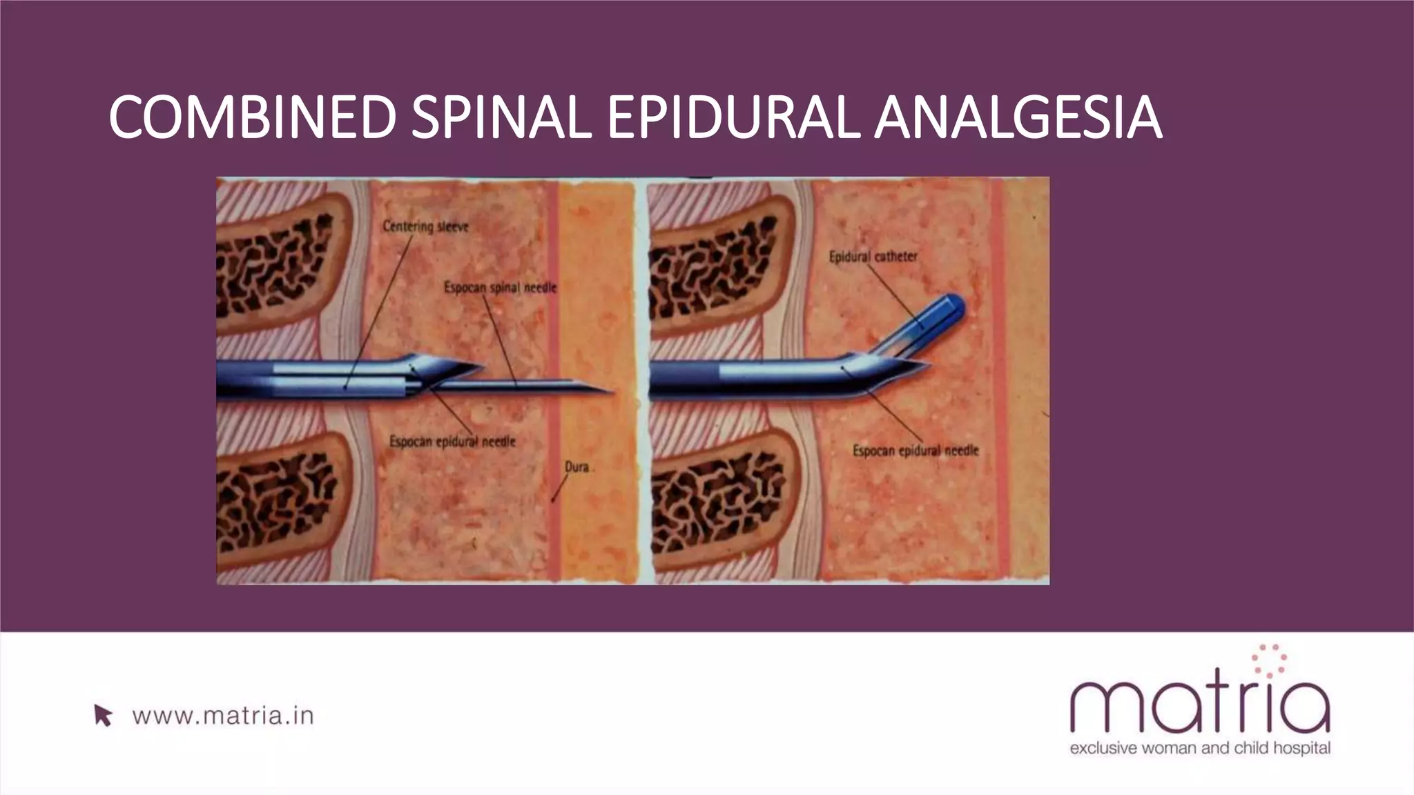 Epidural analgesia for labour | PPTX