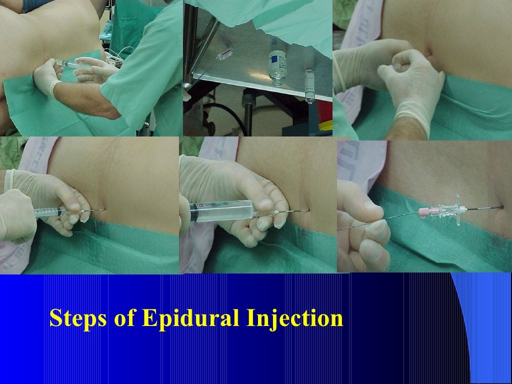 Epidural analgesia in labor