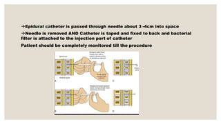 Epidural and spinal anaesthesia.for you alll | PDF
