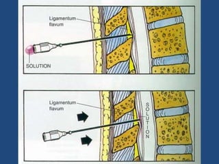 Epidural anesthesia | PPTX