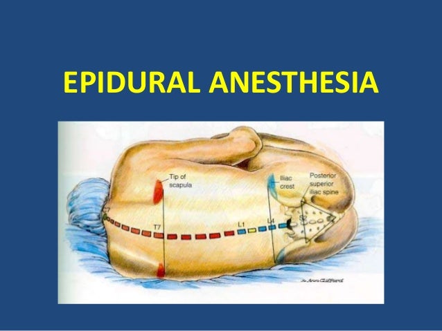 Epidural Anesthesia